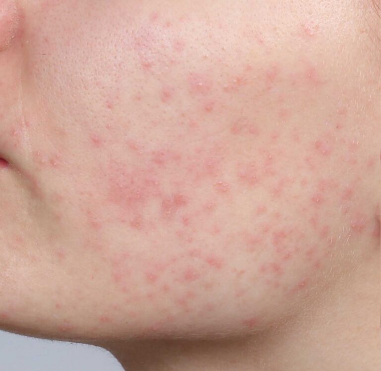 Acne & Pimples - Why Do You Get It & How Can It Be Treated?